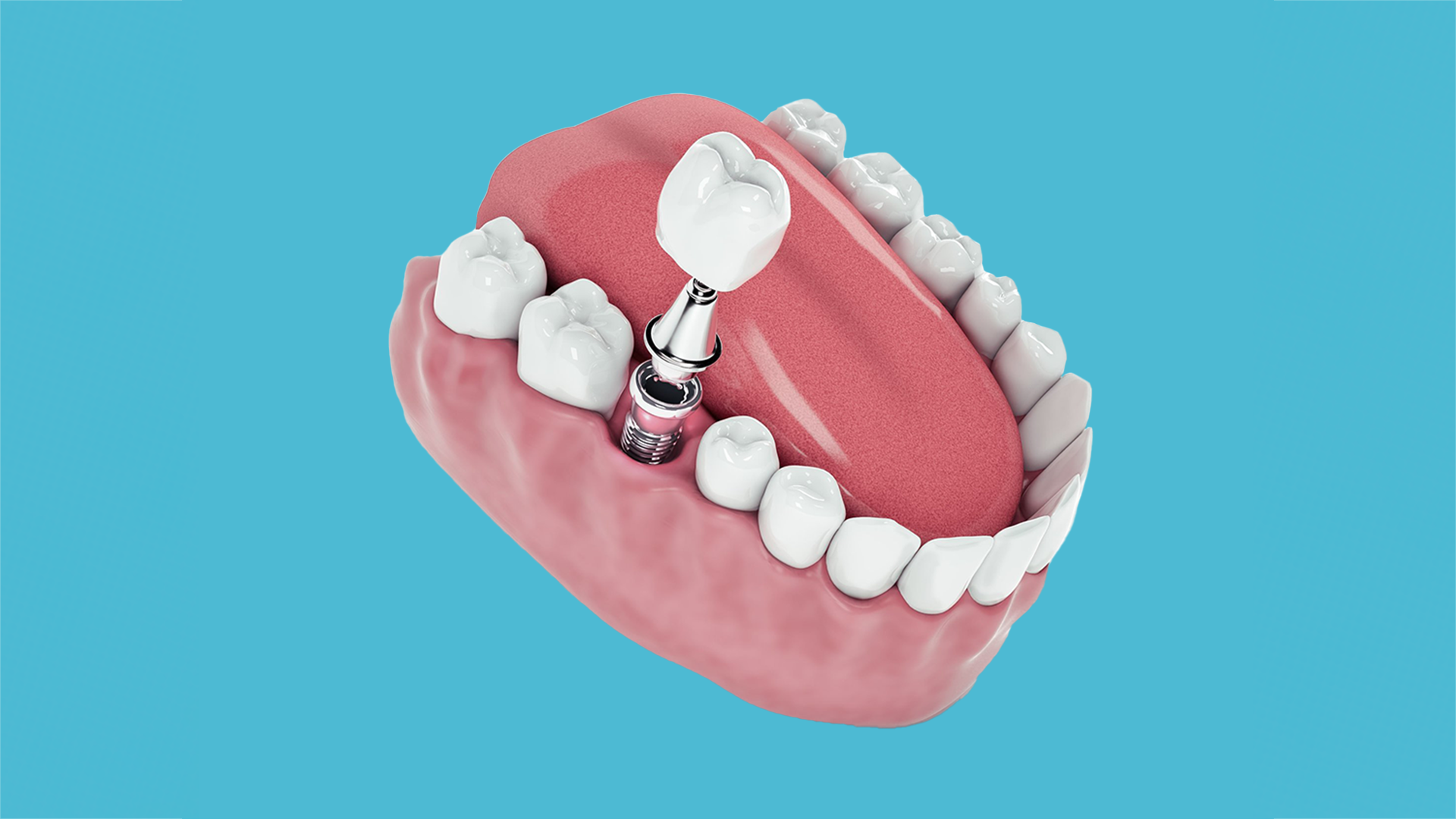 What does dental implantation mean?