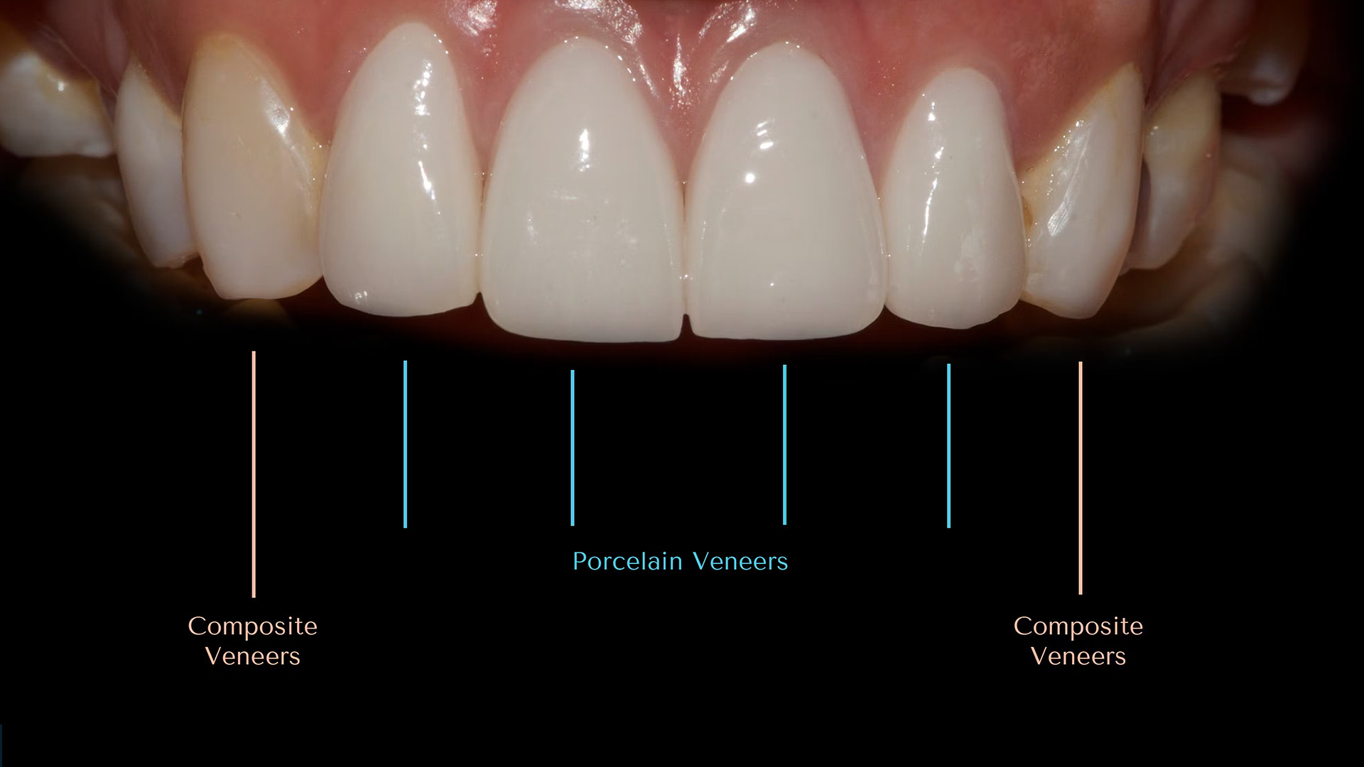 Types of Veneers: The Best Choice for Your Perfect Smile
