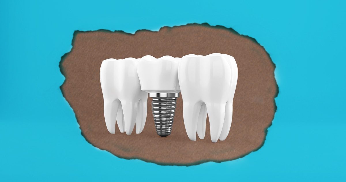 The History Of Implantology Development