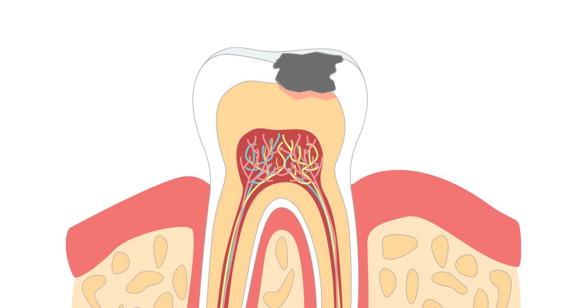 What We Should Know About Caries And Its Stages