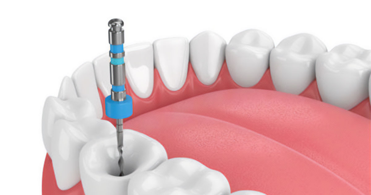 Endodontic Treatment Guidelines at Johnny Duffy blog