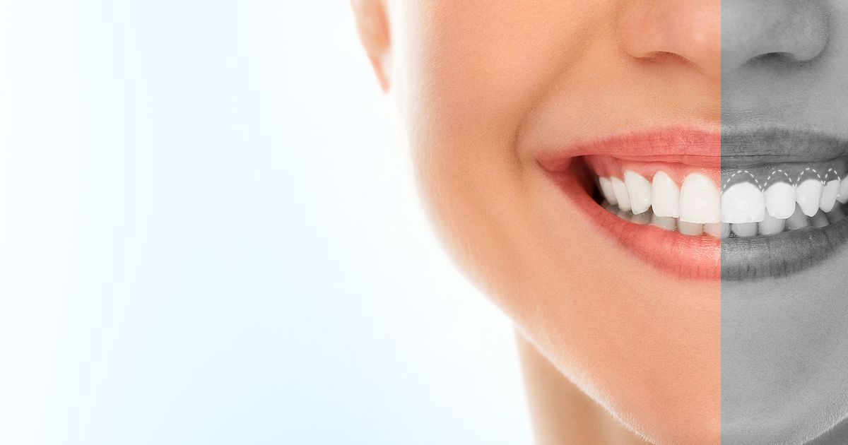 What Is A Gummy Smile And How Can It Be Fixed