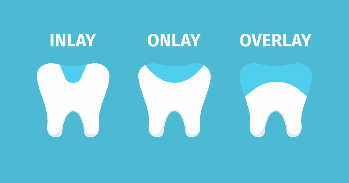 Caries Treatment With Inlay, Onlay And Overlay Dental Fillings