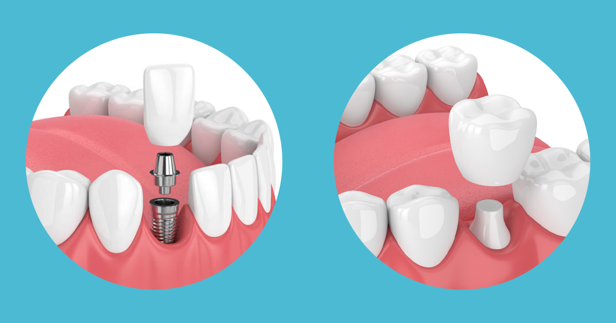 What We Need To Know About Implants And Crowns