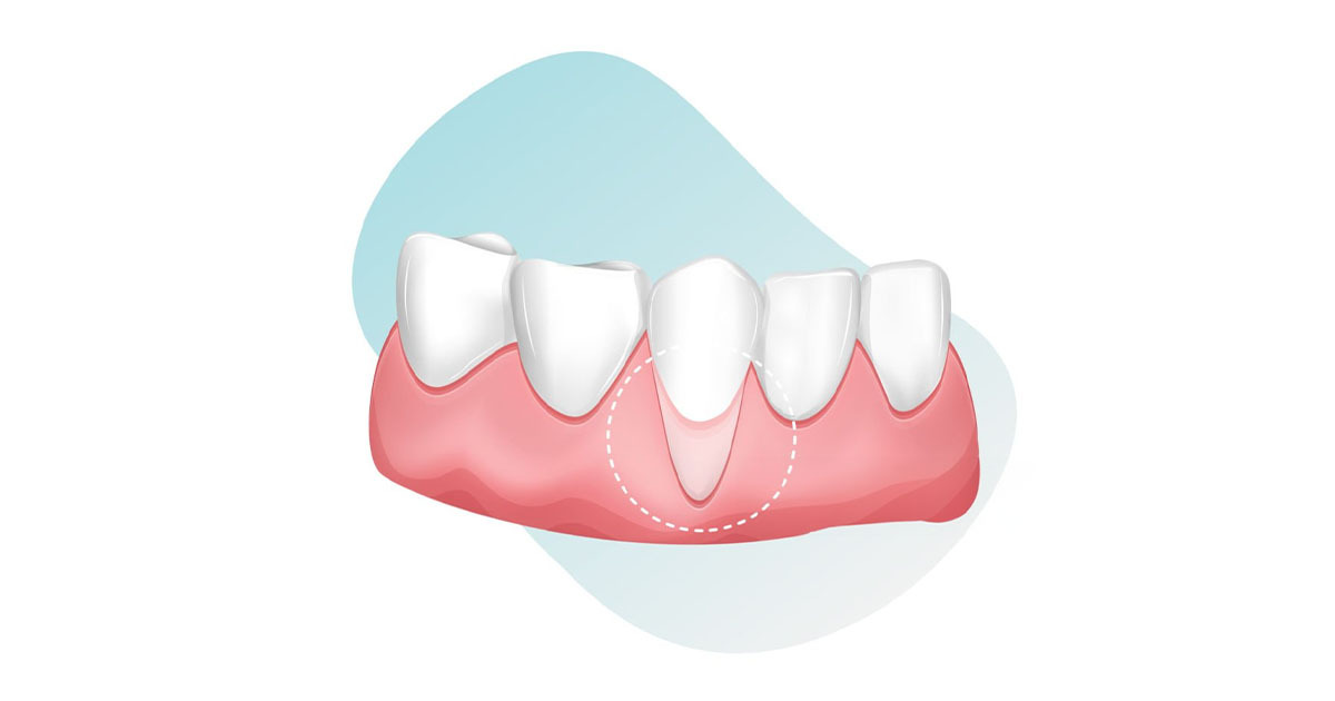 What Is And What Causes Gingival Recession