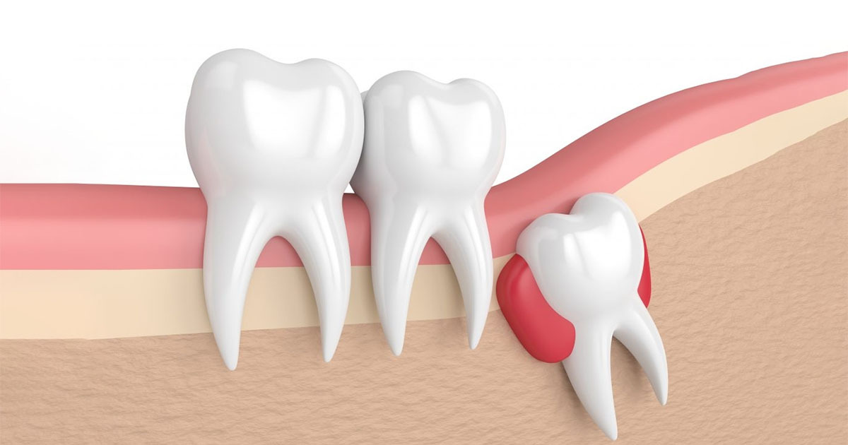 What To Know About Wisdom Teeth