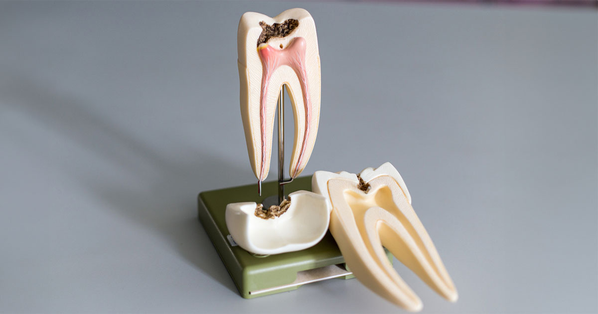 Treatment of tooth canals - endodontics