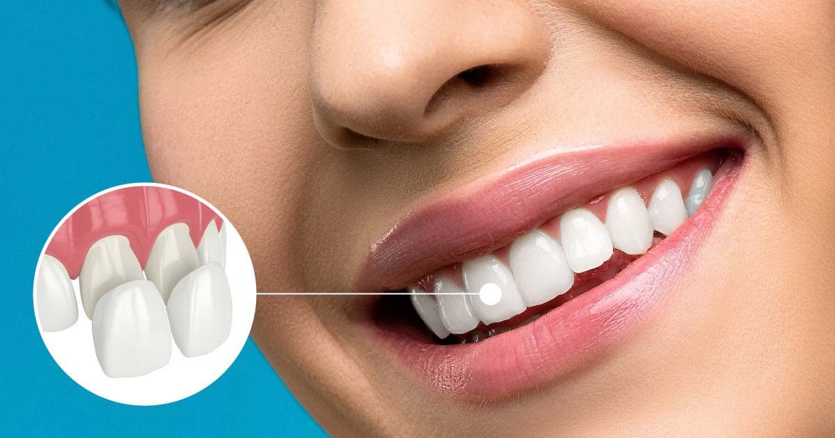 One Solution To All Problems – Veneers